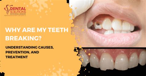 Causes And Solutions For Breaking Teeth