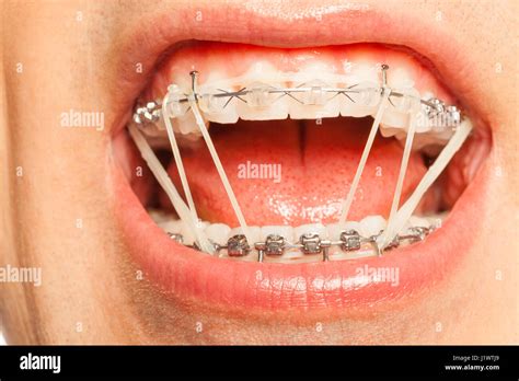 Mans Mouth With Braces And Rubber Correction Strings On Dental Hooks
