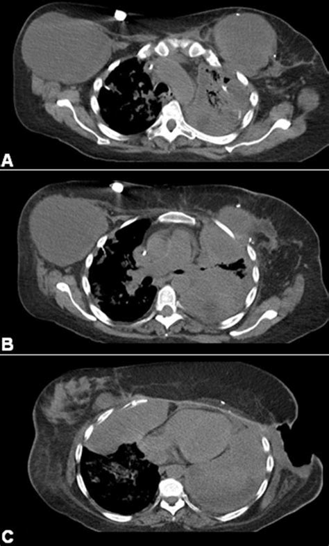 43 Year Old Female With Malignant Phyllodes Tumor Non Enhanced Chest Download Scientific
