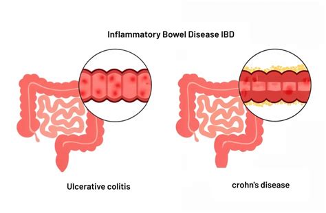 100 Best Ibd Treatment In Chennai The Arc Gut Clinic