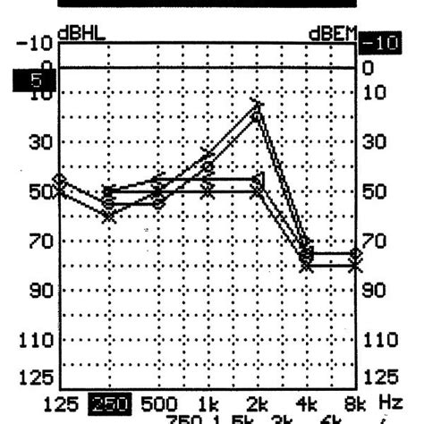The Audiogram Allows The Calculation Of The Pure Tone Average Pta For