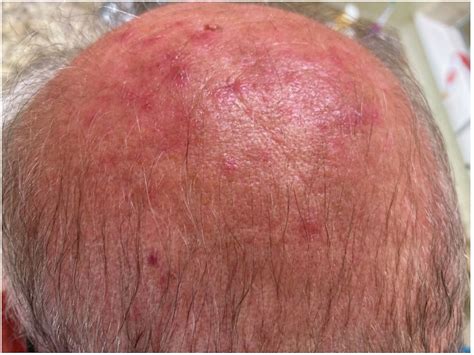 Pustular Rosacea Secondary To Demodex Infestation Shown With