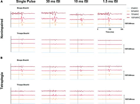 Electromyographic Emg Traces Showing Representative Meps Over A 300