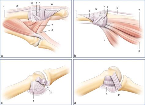 Sprains And Dislocations Of The Fingers Clinical Tree
