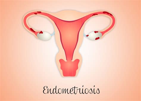 Types Of Endometriosis Staging Of Endometriosis PatientsEngage