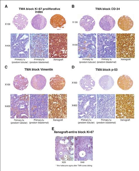 Immunostaining Of Wish Wt Tissue Microarray Tma Of Wish Wt Download Scientific Diagram