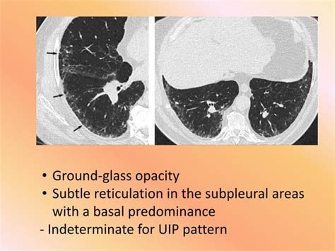 Hrct Basics Of Uip Poster Pptx Lung And Respiratory Health Diseases
