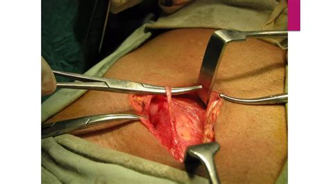 Hernia Operation Ppt