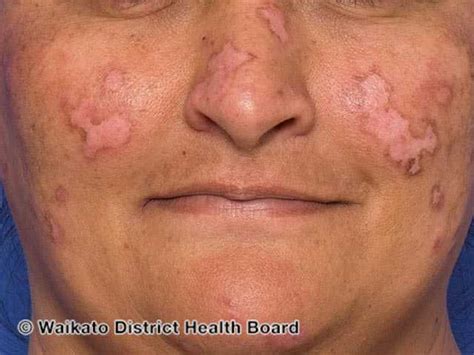 Angular Cheilitis Vs Lupus Rash 4 Differences To Note Mylupusteam