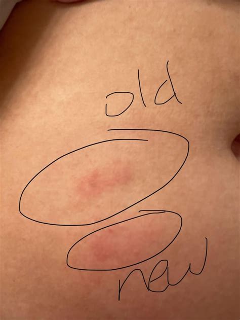 Injection Site Rash Rsemaglutide