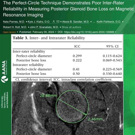 Arthroscopy Journals On Linkedin Posterior Glenoid Bone Loss The