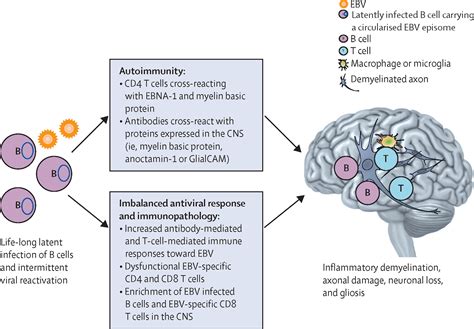 Epstein Barr Virus As A Cause Of Multiple Sclerosis Opportunities For Prevention And Therapy