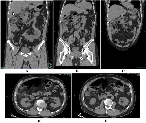 Acute Appendicitis With Retroperitoneal Ectopic Location From Ascending Colon Surgery Case