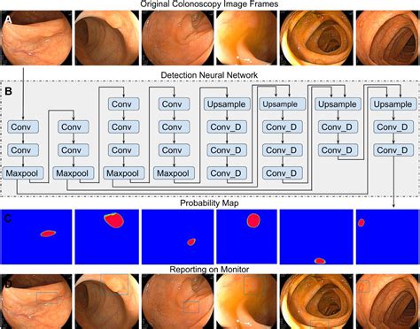 Lower Adenoma Miss Rate Of Computer Aided Detection Assisted Colonoscopy Vs Routine White Light