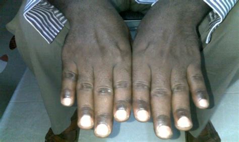 Generalized Hyperpigmentation In Sudanese Patient With Primary Addisons Disease As Autoimmune