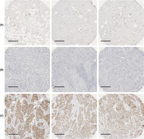 Immunohistochemical Staining Images In Tissue Microarray Tma With