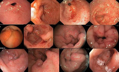 Endoscopic Band Ligation For Watermelon Stomach