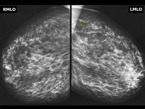 Atlas Of Breast Cancer Early Detection