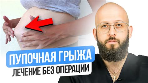 Пупочная грыжа у взрослых как лечить без операции Youtube