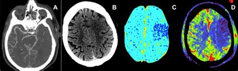 A 74 Year Old Patient With A Proximal Right M1 Segment Middle Cerebral