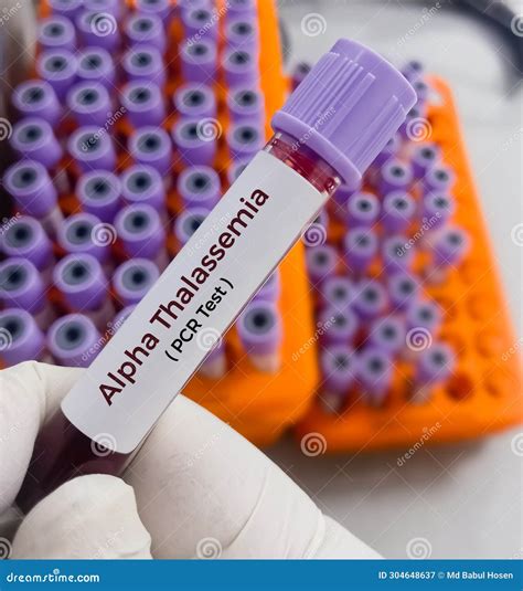 Blood Sample In Hematologist Hand For Alpha Thalassemia Pcr Testing