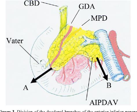 Figure 4 From Segmental Resection Of The Third Portion Of The Duodenum For A Gastrointestinal