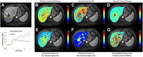 Perfusion Mr Imaging Of Liver Magnetic Resonance Imaging Clinics