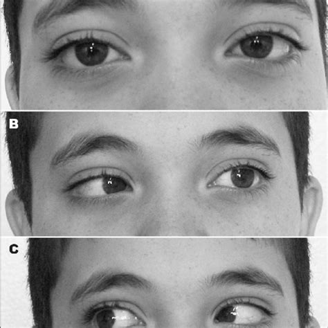 Initial Optic Nerve Appearance The Right Eye Is On The Left And The Download High