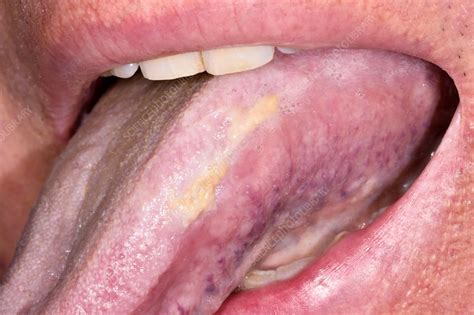 Oral Thrush Stock Image C Science Photo Library