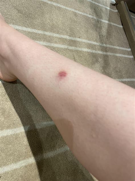 Skin Turning Purple After Bug Bites Rbrazil