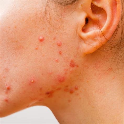 Std On Face