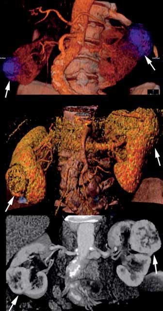 Bilateral Renal Cell Carcinoma Arrows Based On An Arterial Phase Download Scientific Diagram