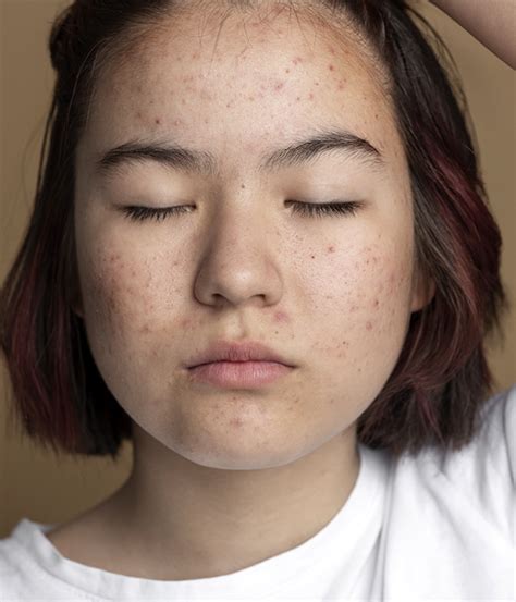 How To Minimize Acne Scars 8 Proven Methods Shinesheets Elevate Your Life