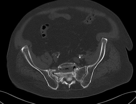 Bilateral Fracture Of The Sacrum With Moderate Displacement On The Download Scientific Diagram
