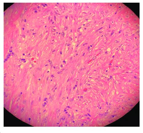 Pleural Surgical Specimen With Fibrotic Changes Download Scientific Diagram