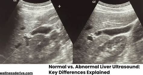 Normal Vs Abnormal Liver Ultrasound Key Differences Explained