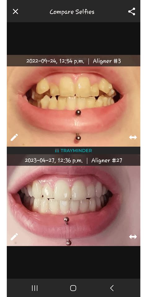 Finished Treatment R Invisalign