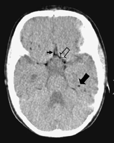 Intraosseous Infusion Needle Correctly Positioned Within The Proximal Download Scientific