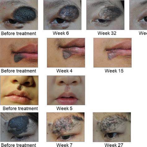 Congenital Melanocytic Nevus Cmn Clinical Appearance Before Week 0 Download Scientific