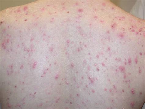 Acne Conglobata Pictures Causes And Treatment