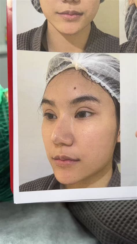 แก้จมูก รองกระดูกอ่อนหลังใบหู เนื้อเยื่อหลังหู และเนื้อเยื่อเทียม ตอกฐาน เดิม ปัญหา ปลายบาง ตึง