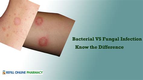 Difference Between Bacterial And Fungal Infections Explained