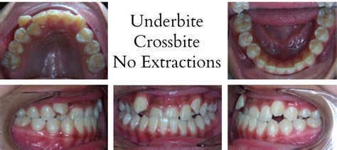 Crossbite Braces Before After