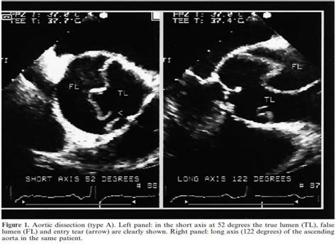Transesophageal Echocardiographytee Pptx
