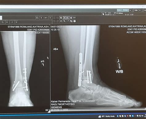 Trimalleolar Fracture R Brokenbones