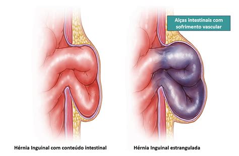Hernia Inguinal Indireta
