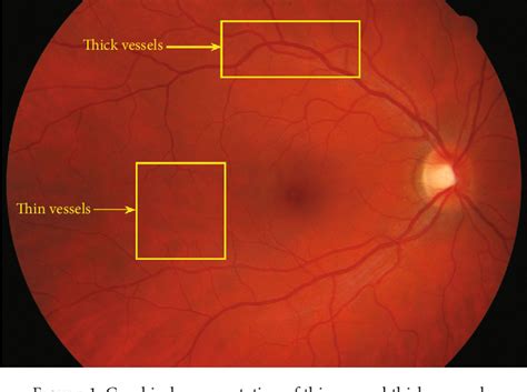 Figure 1 From A Hybrid Unsupervised Approach For Retinal Vessel