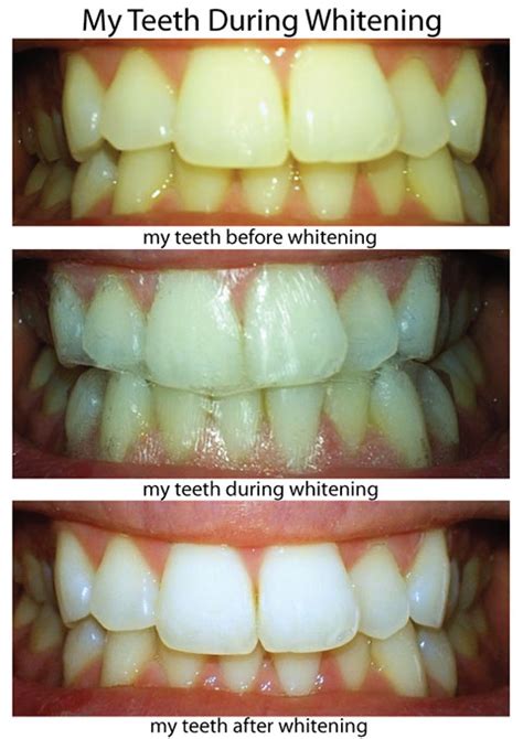 Crest 3d Whitestrips Professional Effects Review Crest 3d Whitestrips Professional Effects Review