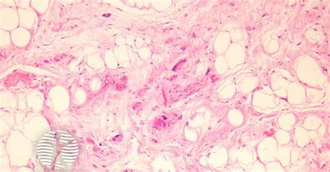 Pleomorphic Lipoma Pathology Image