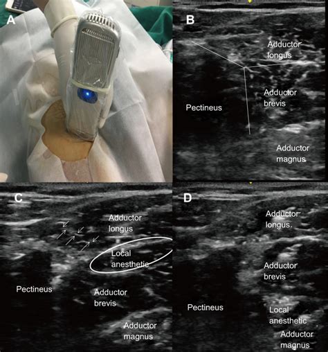 Effect Of Ultrasound Guided Proximal And Distal Approach For Obturator Cmar